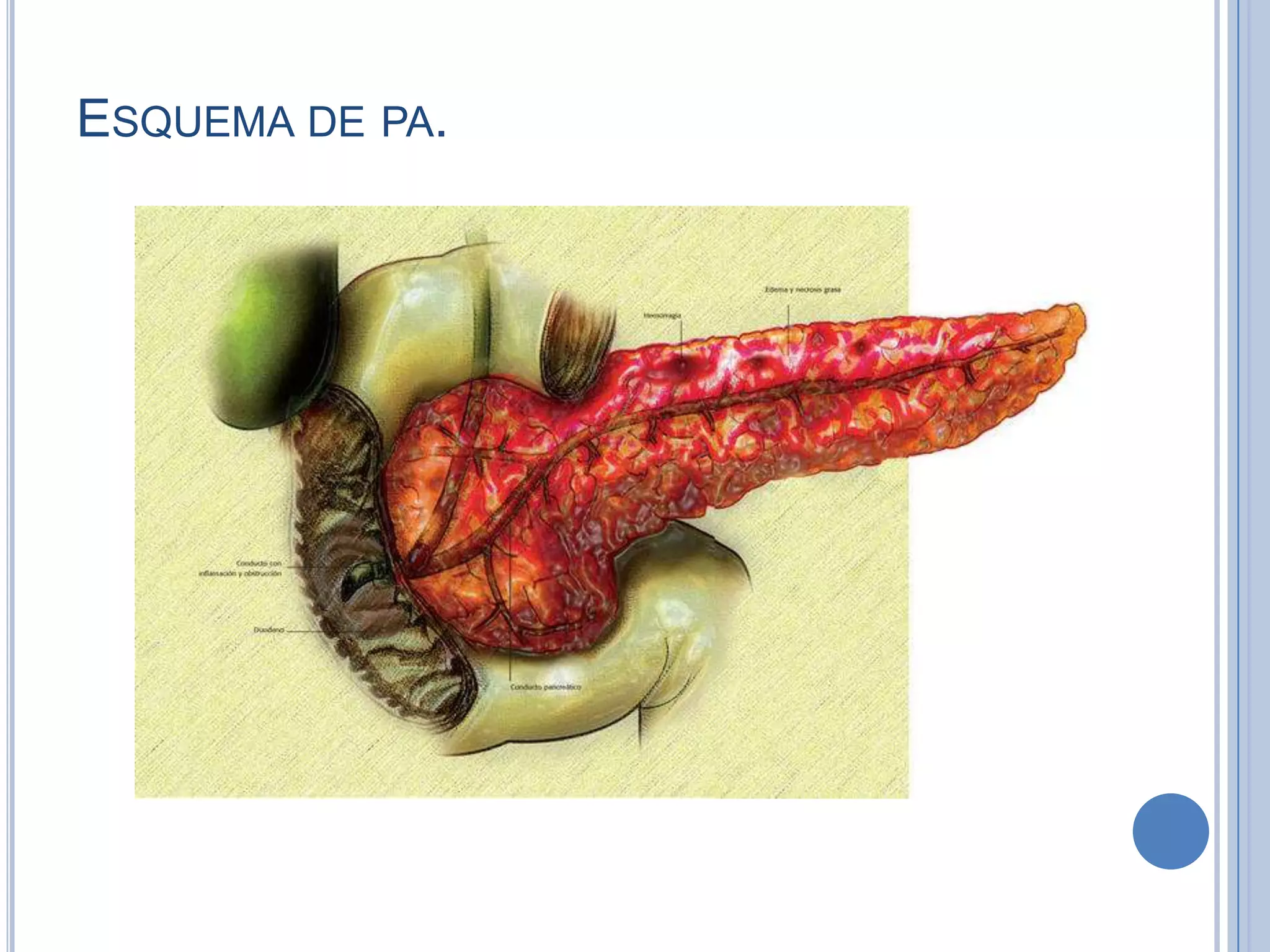 Pancreatitis aguda por TC | PPTX