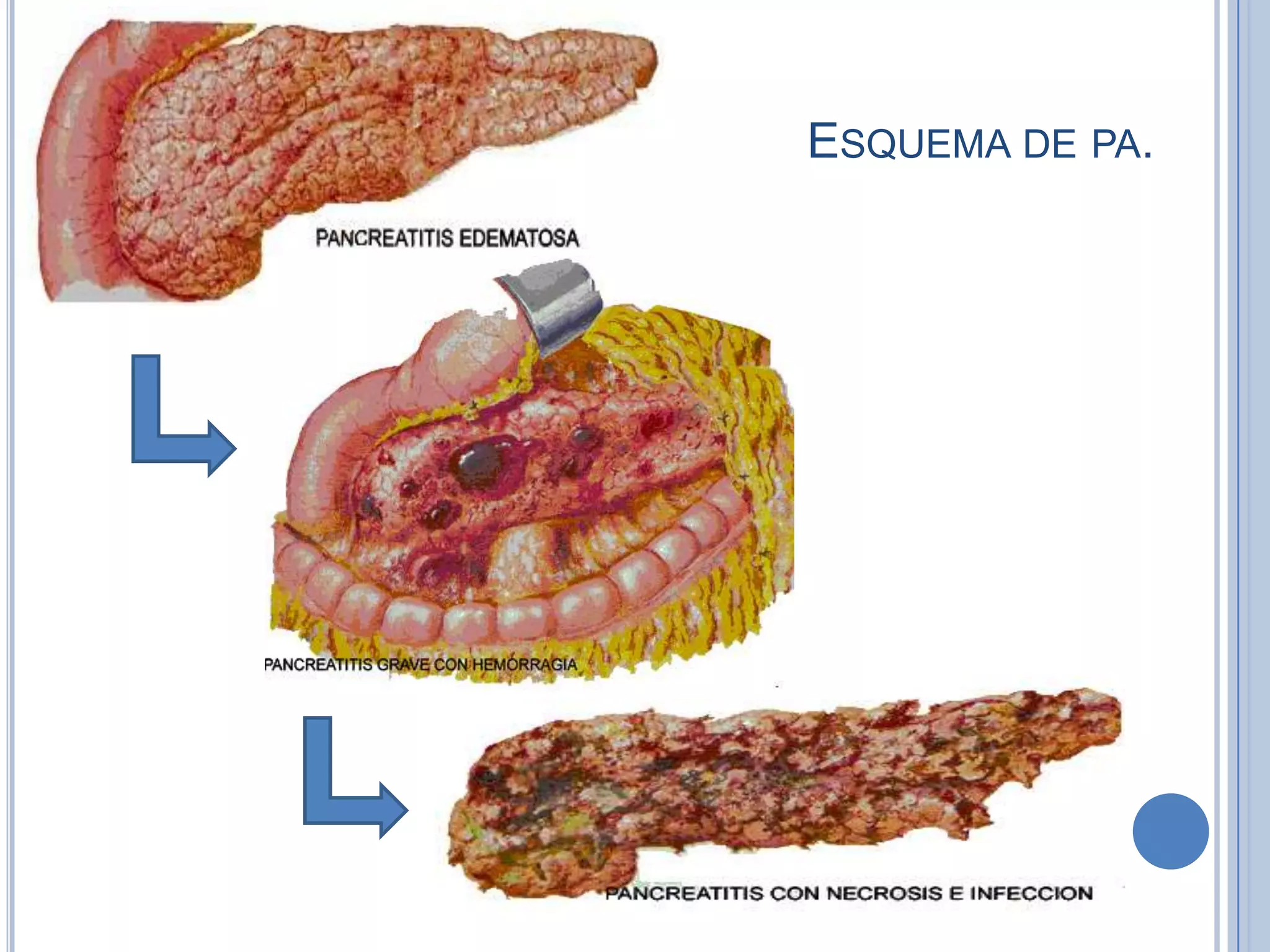 Pancreatitis aguda por TC | PPTX