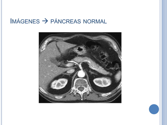 Pancreatitis aguda por TC | PPTX