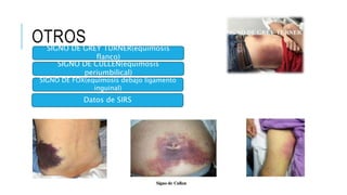 PANCREATITIS AGUDA GASTROENTEROLOGIA MEDICINA | PPTX