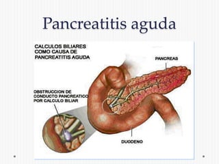 Pancreatitis aguda y crónica | PPTX