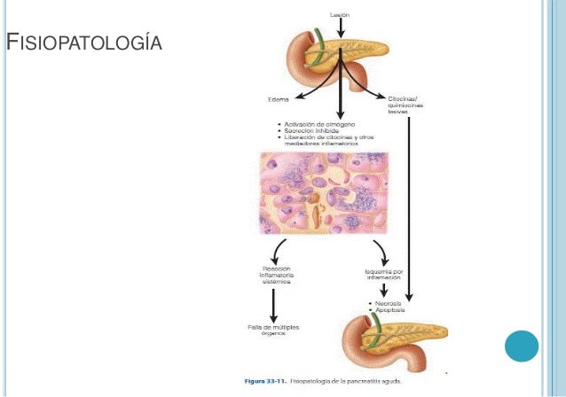 Pancreatitis aguda y cronica