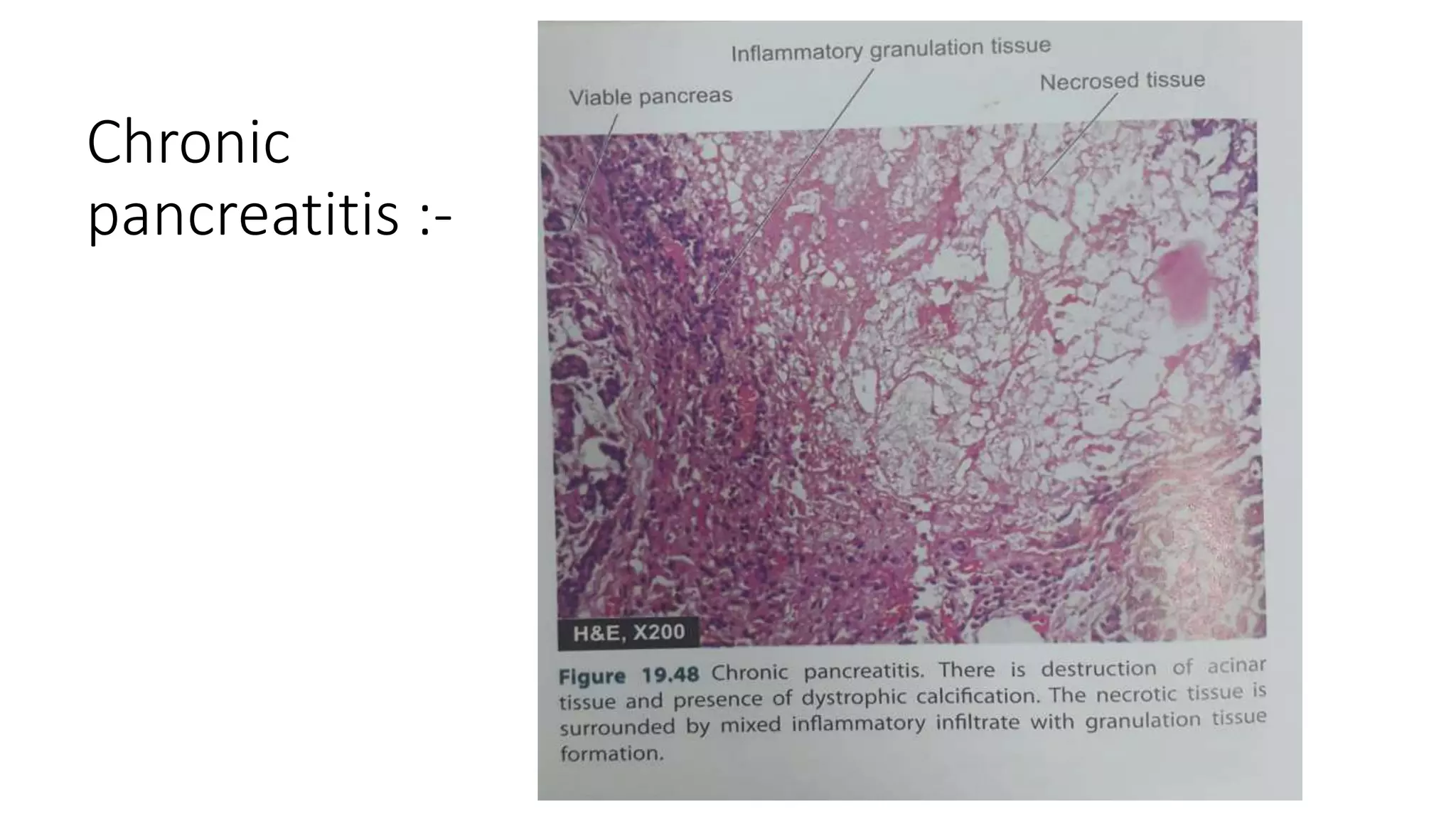 Pancreatitis and peritonitis | PPTX
