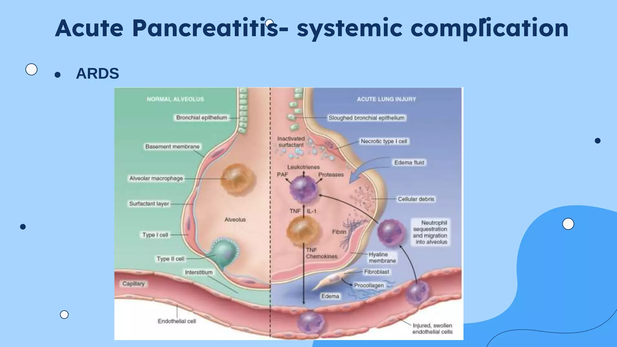 Pancreatitis Complications - pptx | PPT