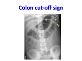 PANCREATITIS ....................................... | PPTX