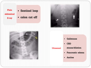 Acute Pancreatitis | PPT