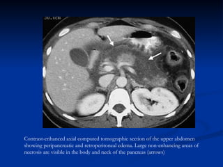 ACUTE AND CHRONIC PANCREATITIS. I ABUZEID.ppt