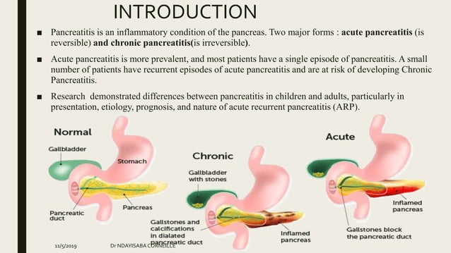 Pancreatitis in pediatrics | PPT