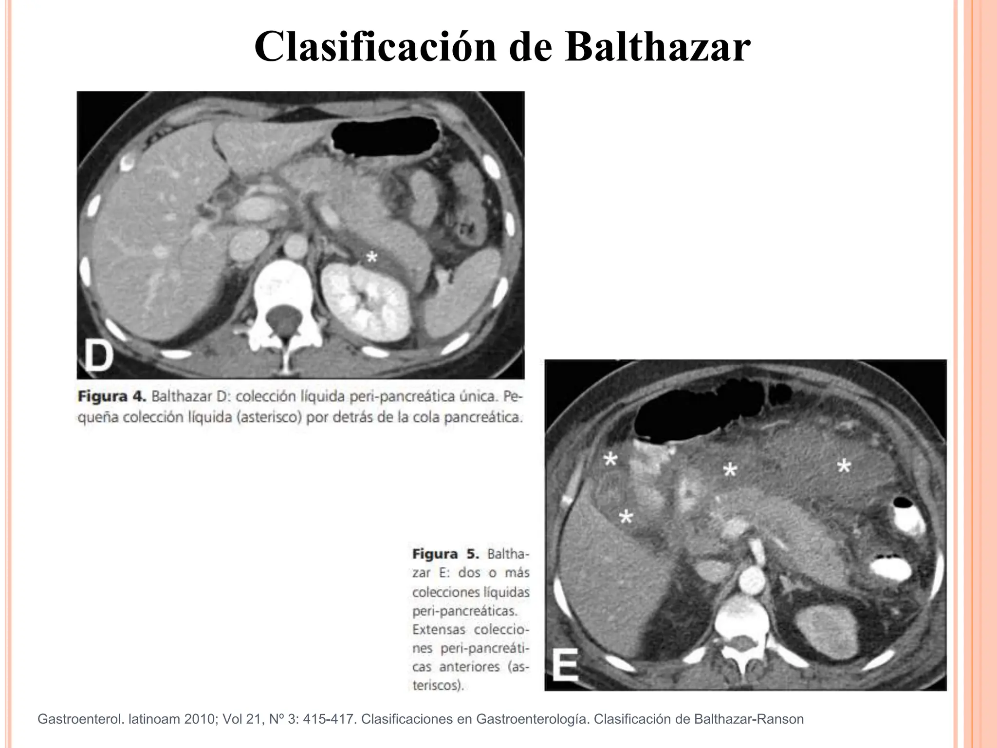 Pancreatitis aguda, clasificacion, dianostico y tratamiento. | PPTX
