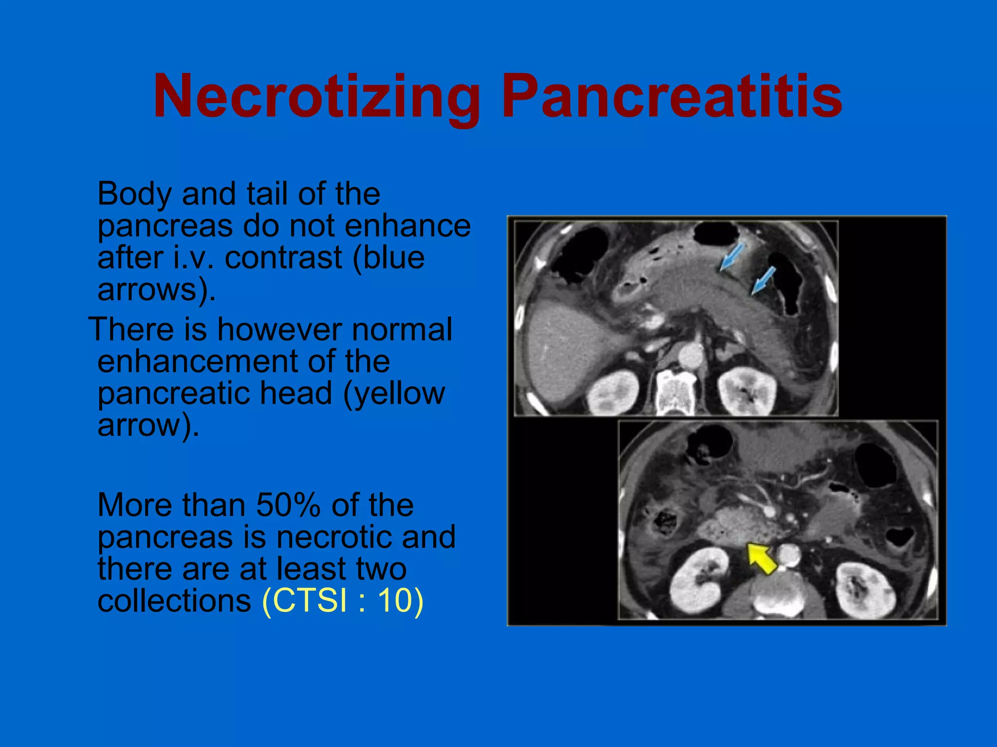 Pancreatitis scoring and terminology | PPT