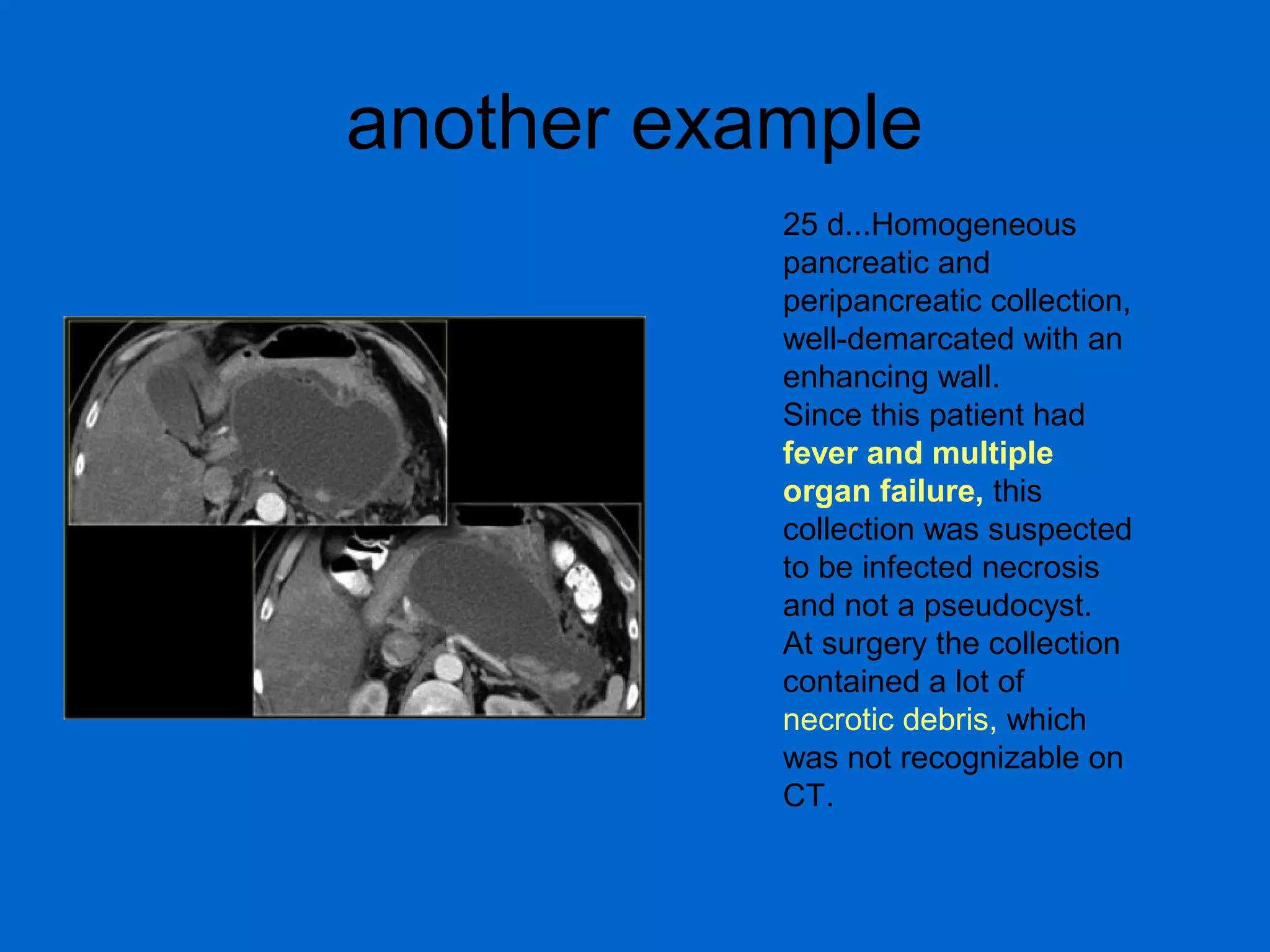 Pancreatitis scoring and terminology | PPT