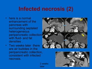 Pancreatitis scoring and terminology | PPT