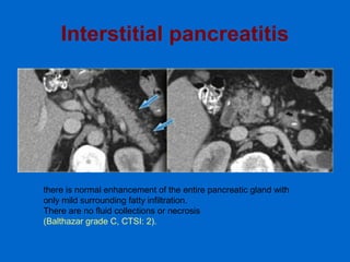 Pancreatitis scoring and terminology | PPT