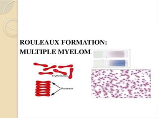 Diagnostic Approach to Pancytopenia Clinical PBS and Bone Marrow | PPTX