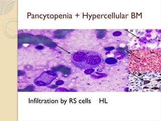 Diagnostic Approach to Pancytopenia Clinical PBS and Bone Marrow | PPT