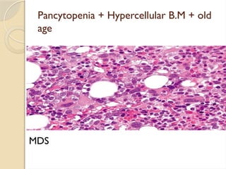Diagnostic Approach to Pancytopenia Clinical PBS and Bone Marrow | PPTX