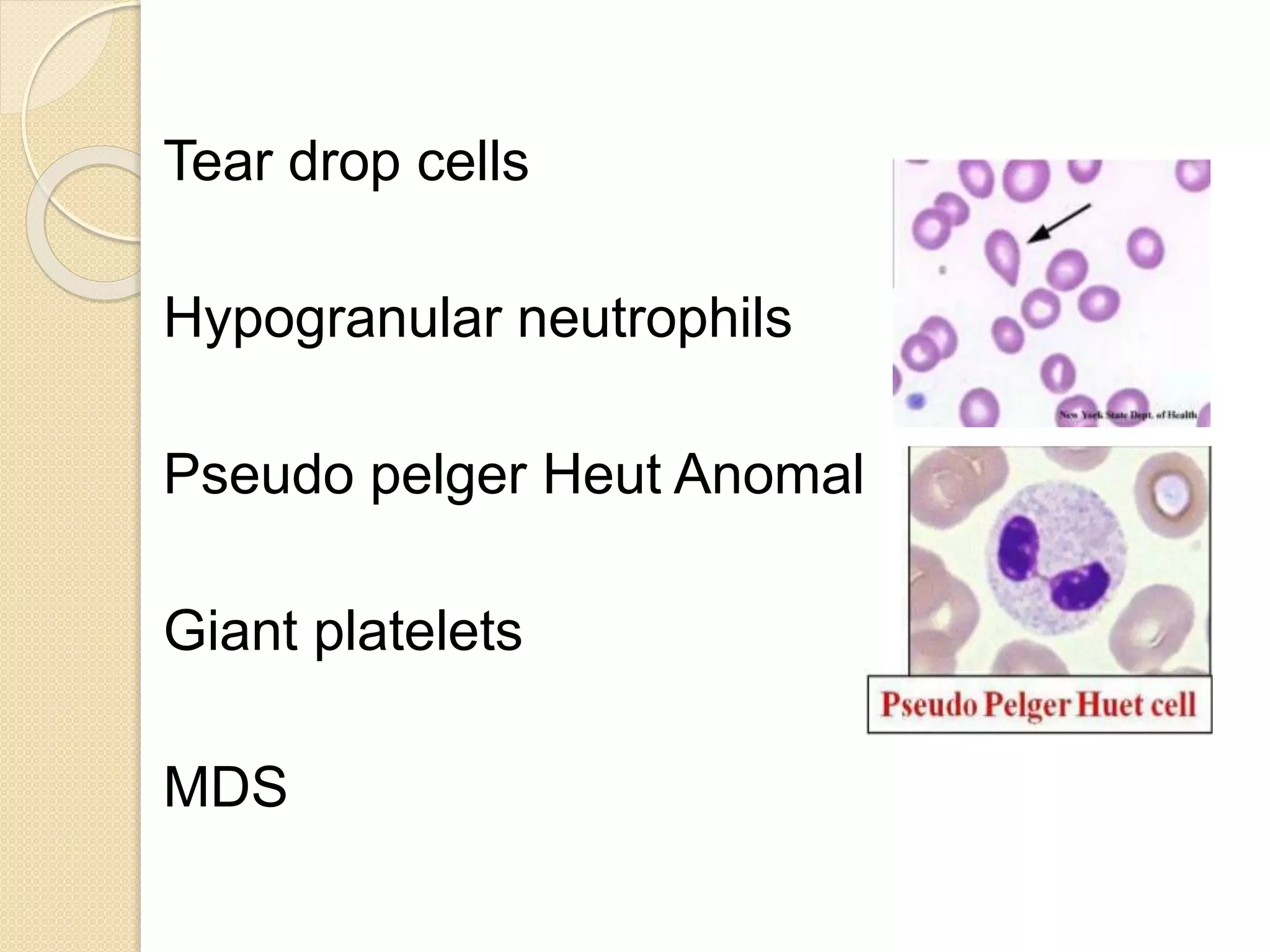 Pancytopenia | PPTX