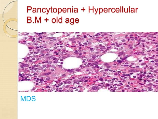 Pancytopenia | PPTX | Blood Disorders | Diseases and Conditions