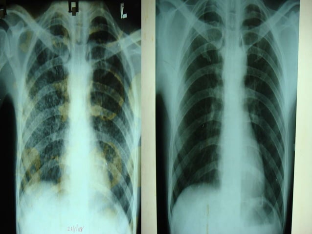 X-Ray: Miliary Tuberculosis | PPT | Diseases and Conditions | Medical Health