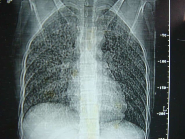 X-Ray: Miliary Tuberculosis | PPT | Diseases and Conditions | Medical Health