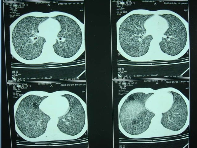 X-Ray: Miliary Tuberculosis | PPT | Diseases and Conditions | Medical Health