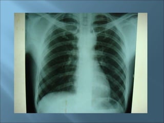 Chest X Ray Miliary Tb