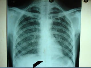 Miliary Tuberculosis X Ray