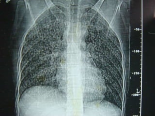 Chest X Ray Miliary Tb
