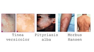 PANEL MODUL BERCAK PUTIH BLOK TROPIS FAKULTAS KEDOKTERAN UMI | PPTX