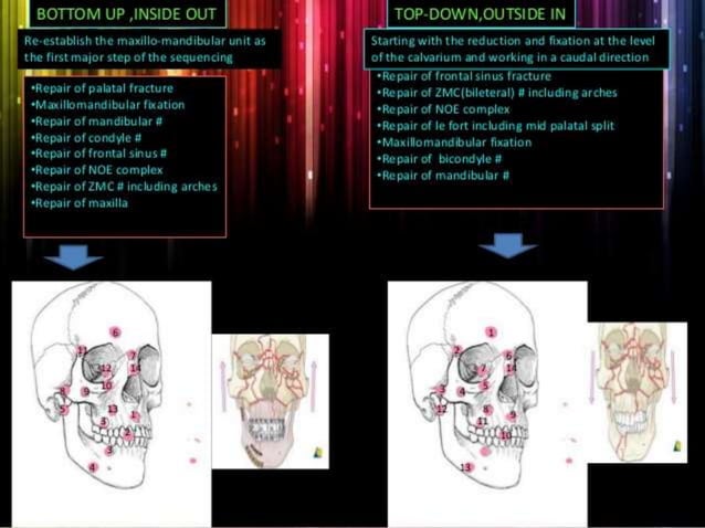 Panfacial fractures | PPT
