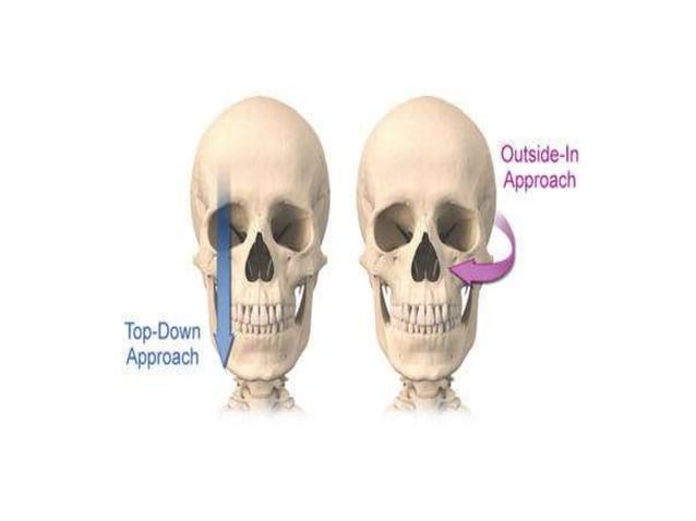 Panfacial fractures | PPTX