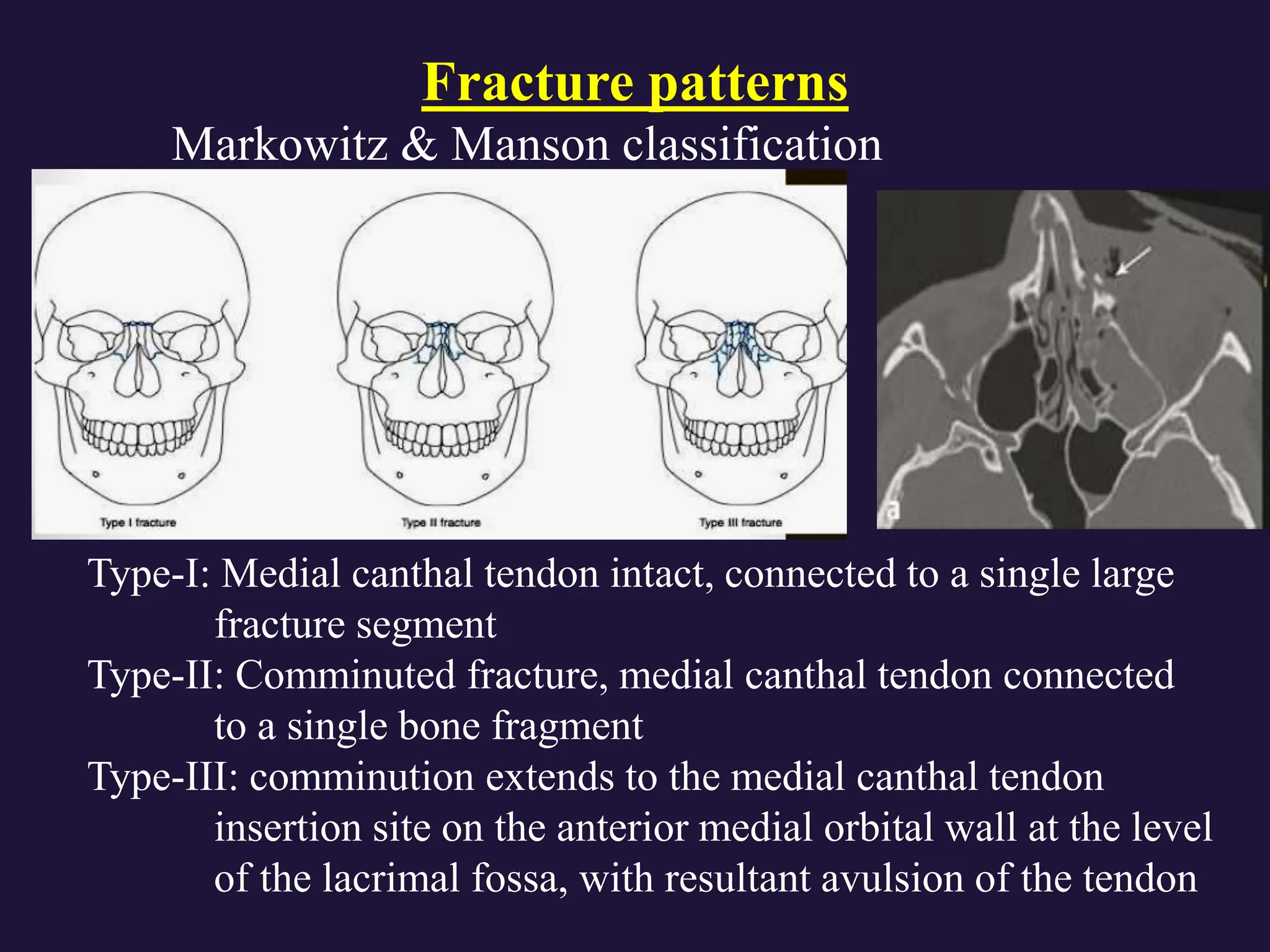 panfacial fractures- anatomy, clinical features, radiology.pptx | Death ...