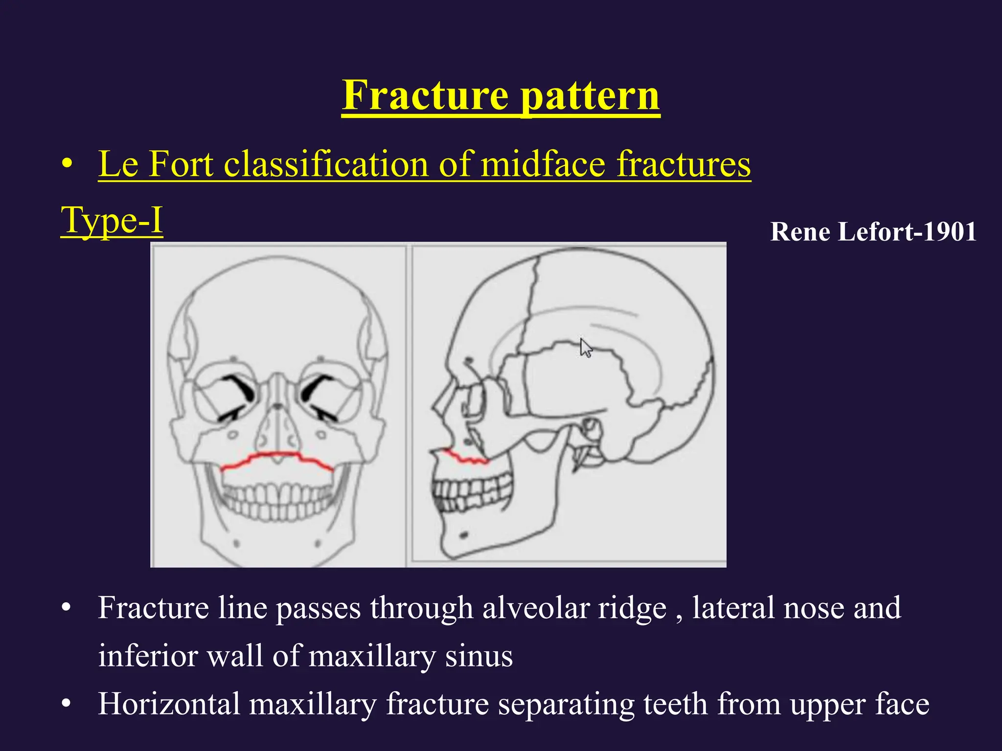 panfacial fractures- anatomy, clinical features, radiology.pptx