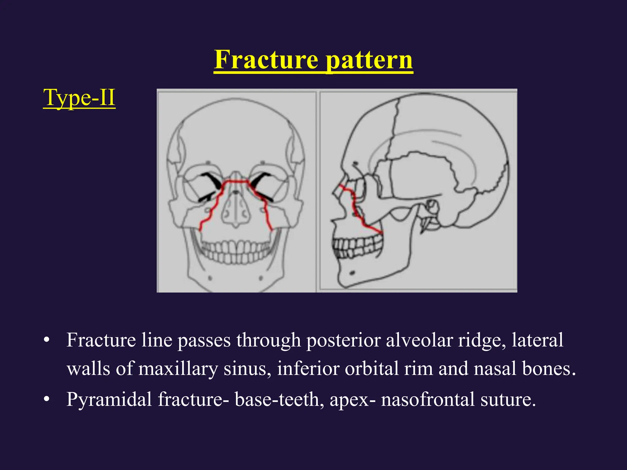 panfacial fractures- anatomy, clinical features, radiology.pptx