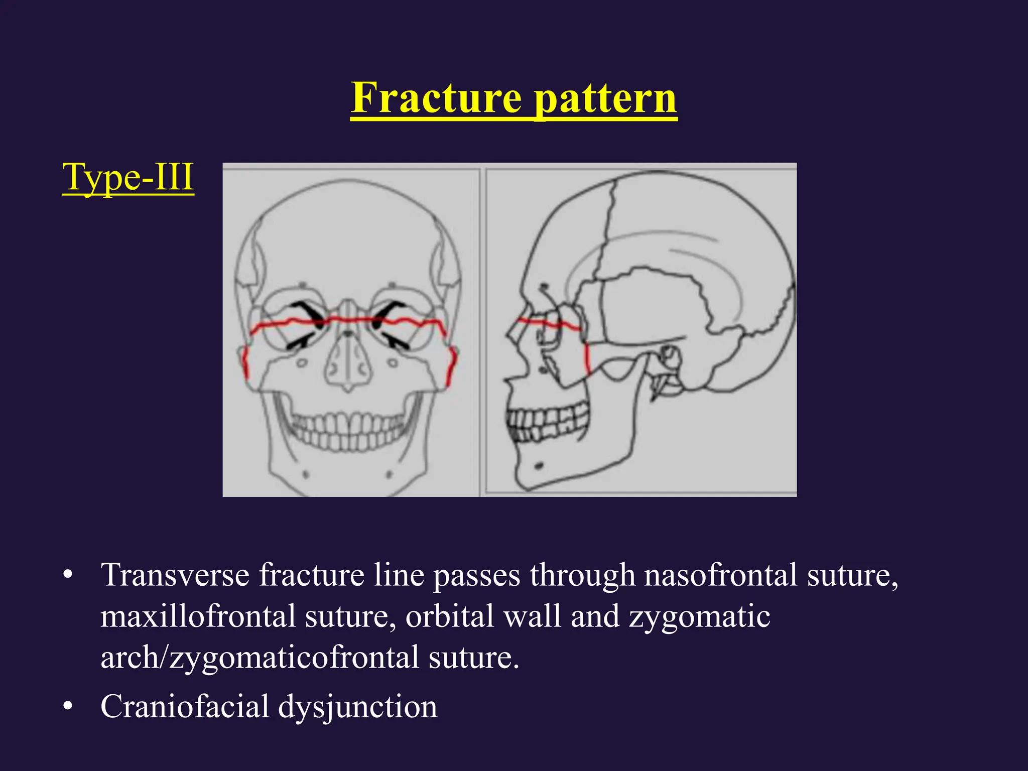 panfacial fractures- anatomy, clinical features, radiology.pptx