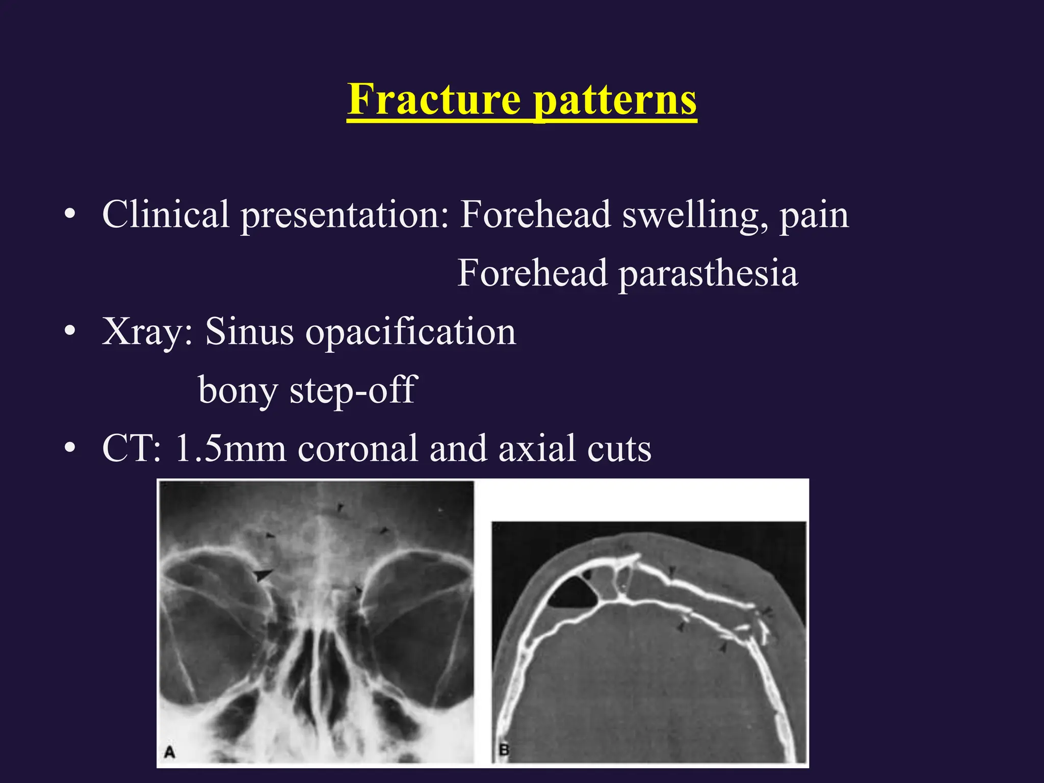 panfacial fractures- anatomy, clinical features, radiology.pptx