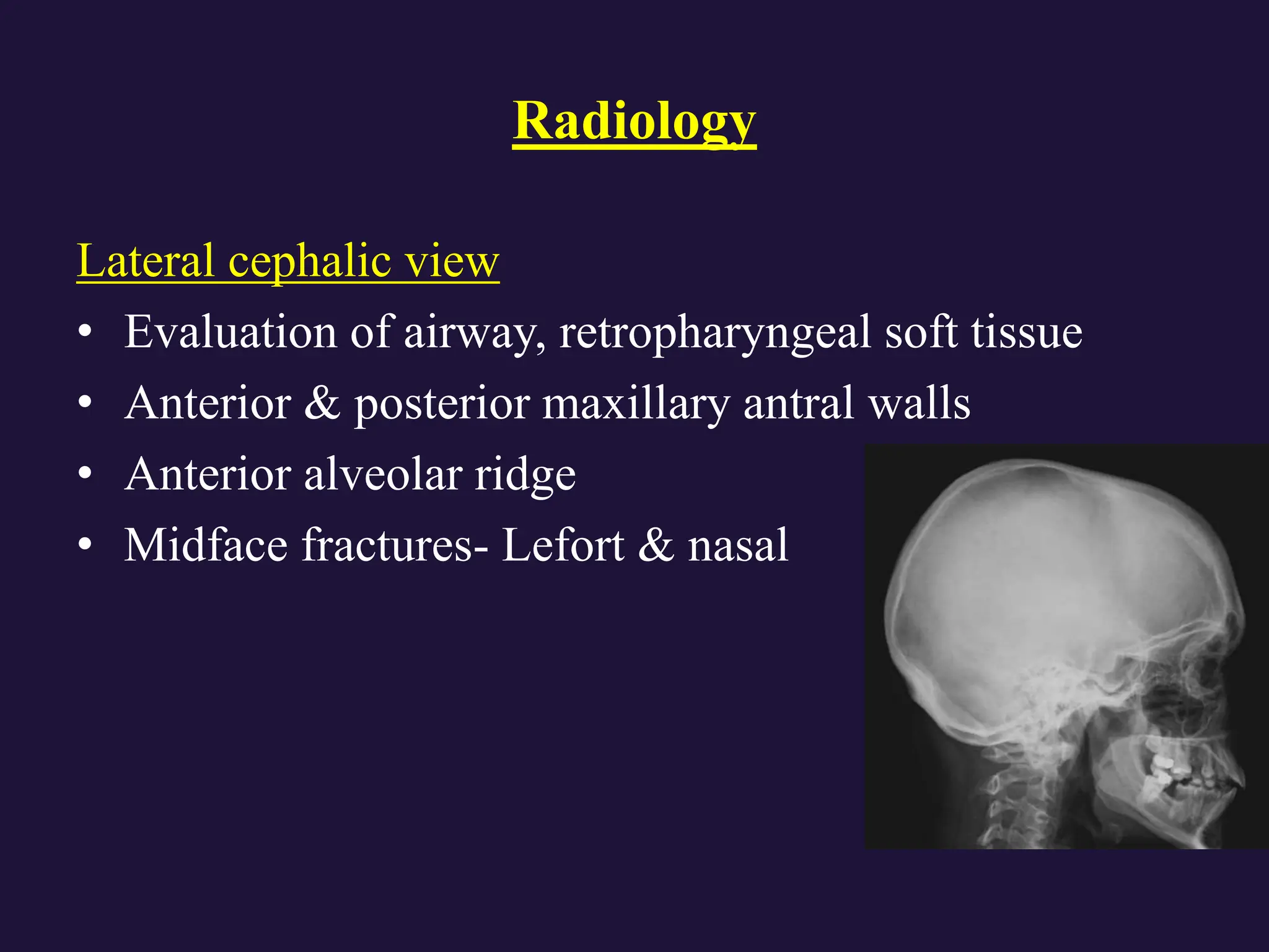 panfacial fractures- anatomy, clinical features, radiology.pptx