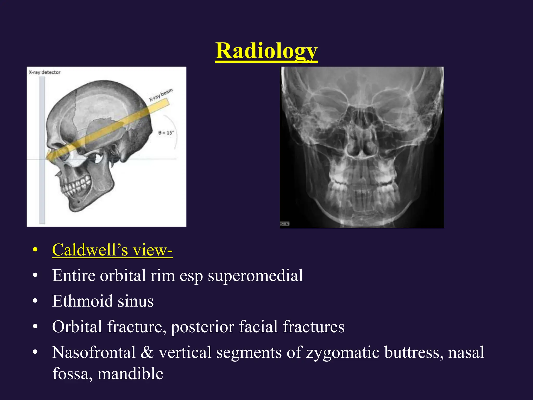 panfacial fractures- anatomy, clinical features, radiology.pptx