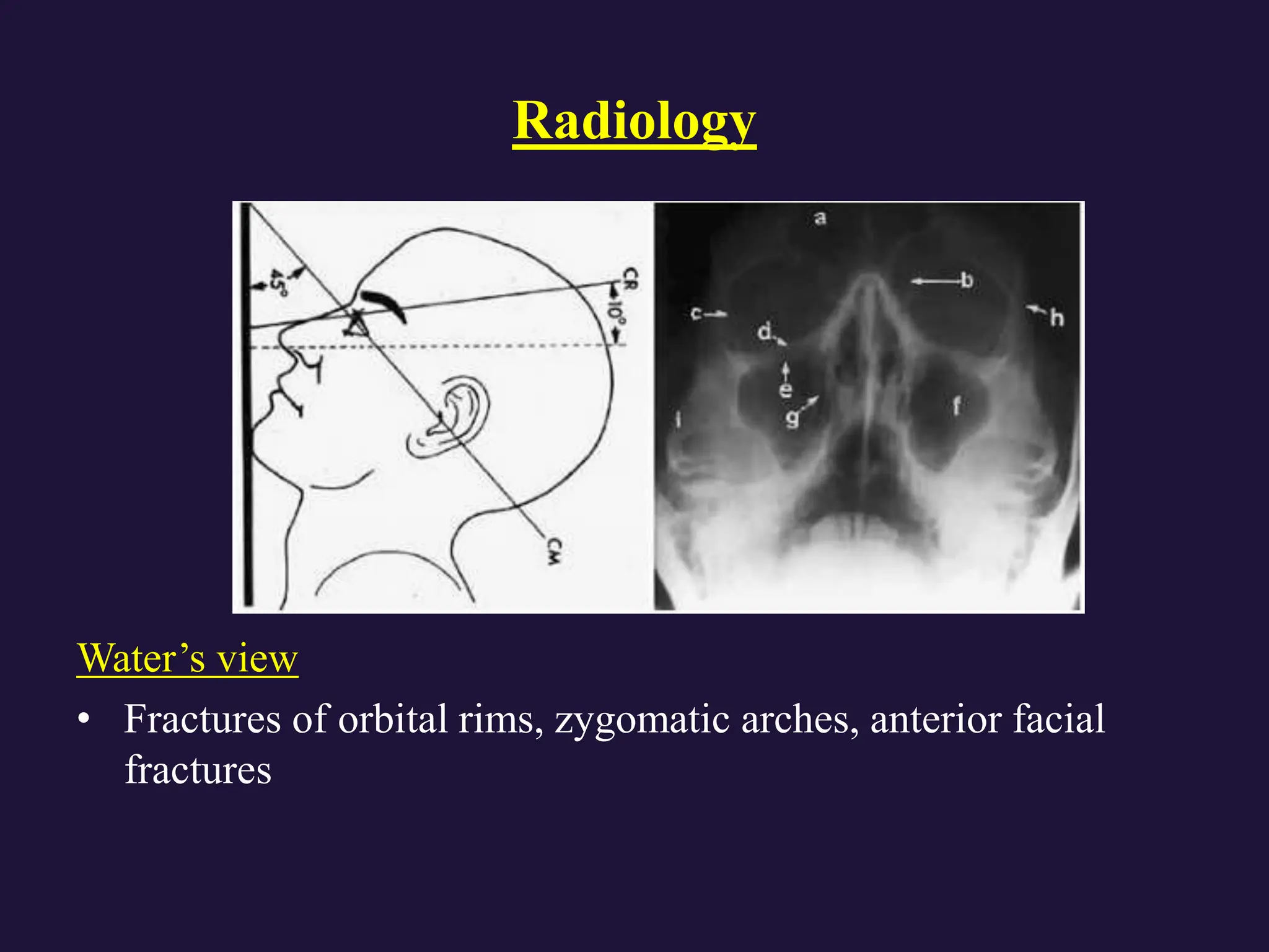 panfacial fractures- anatomy, clinical features, radiology.pptx
