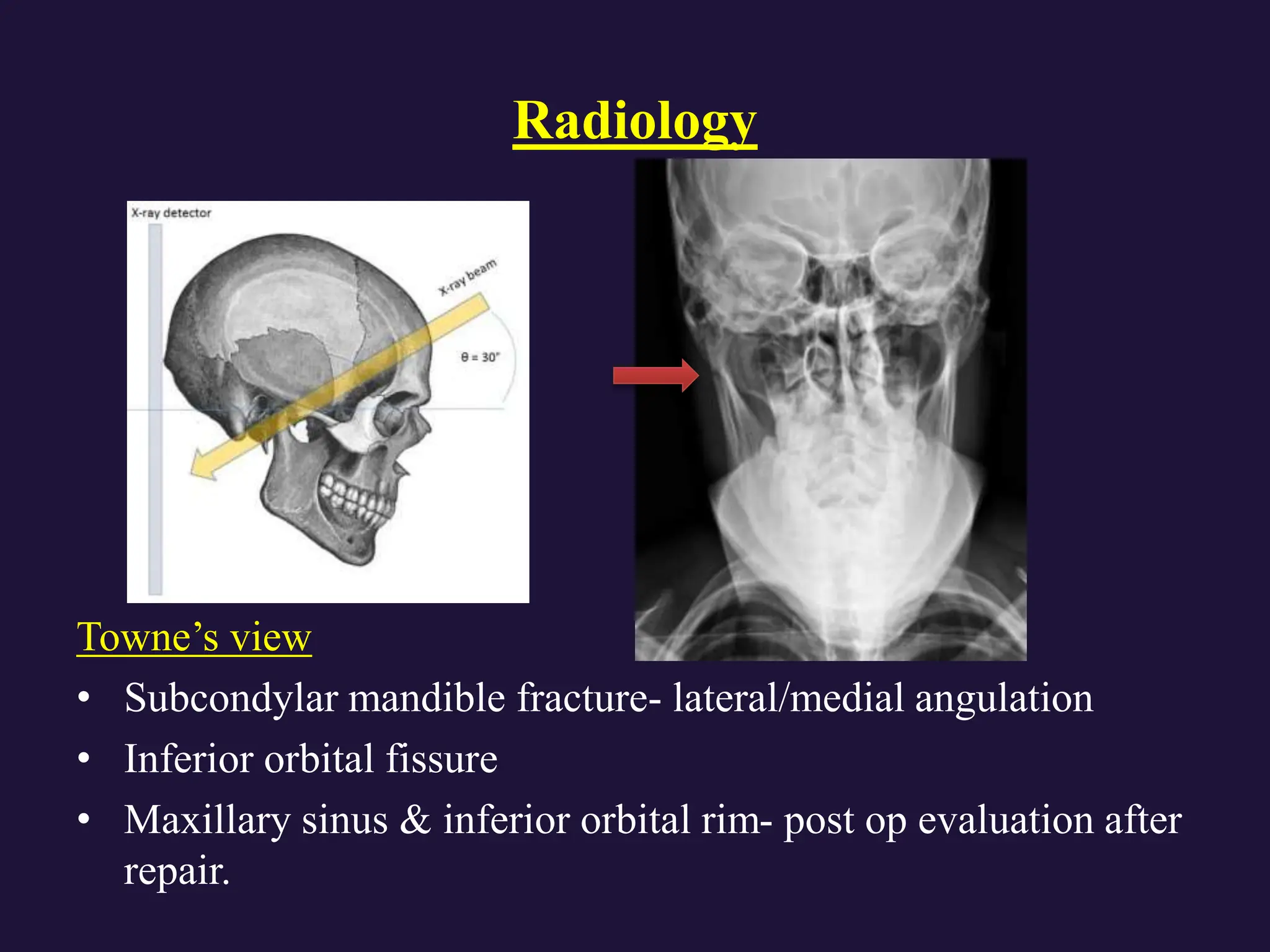 panfacial fractures- anatomy, clinical features, radiology.pptx