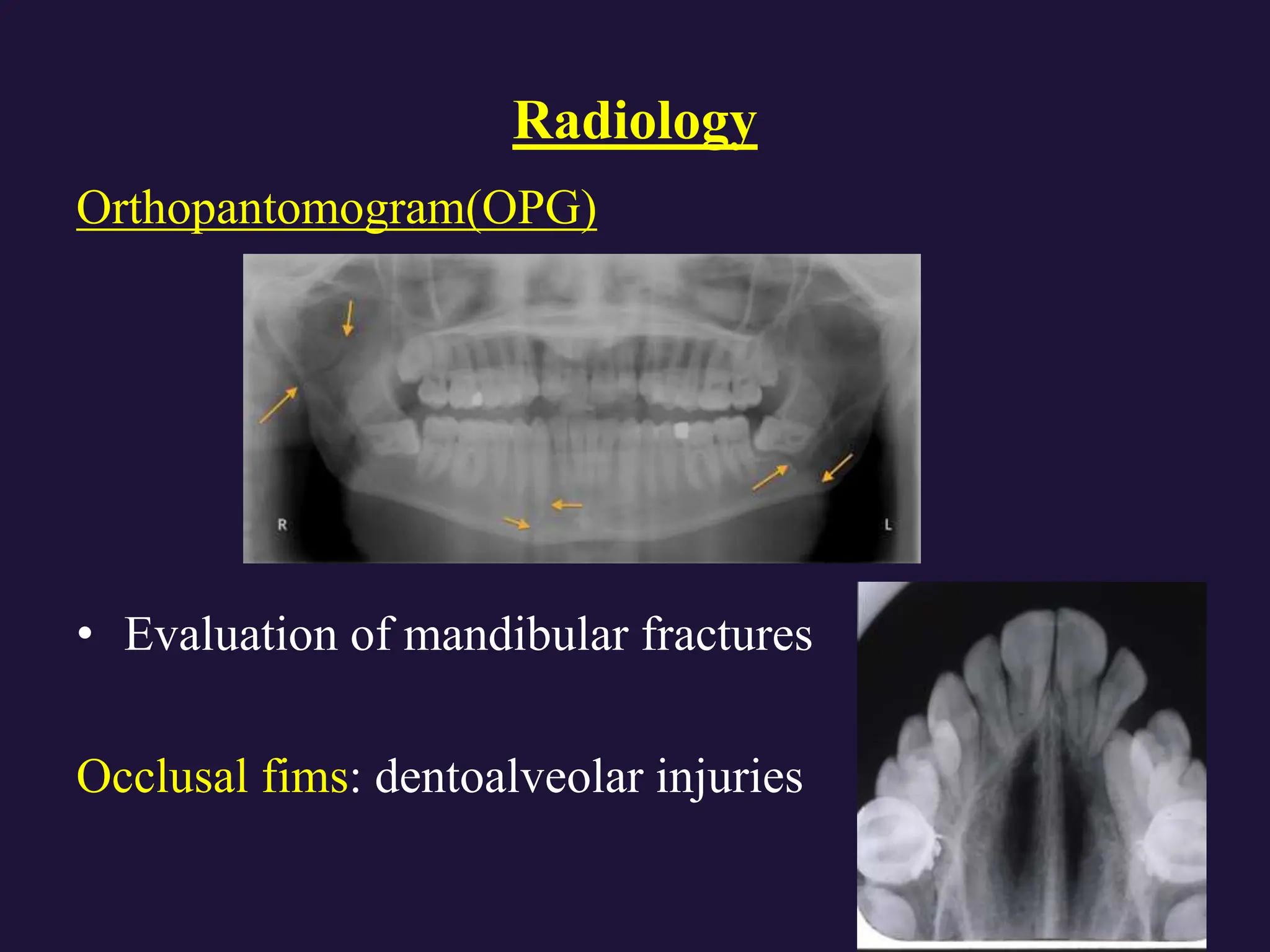 panfacial fractures- anatomy, clinical features, radiology.pptx