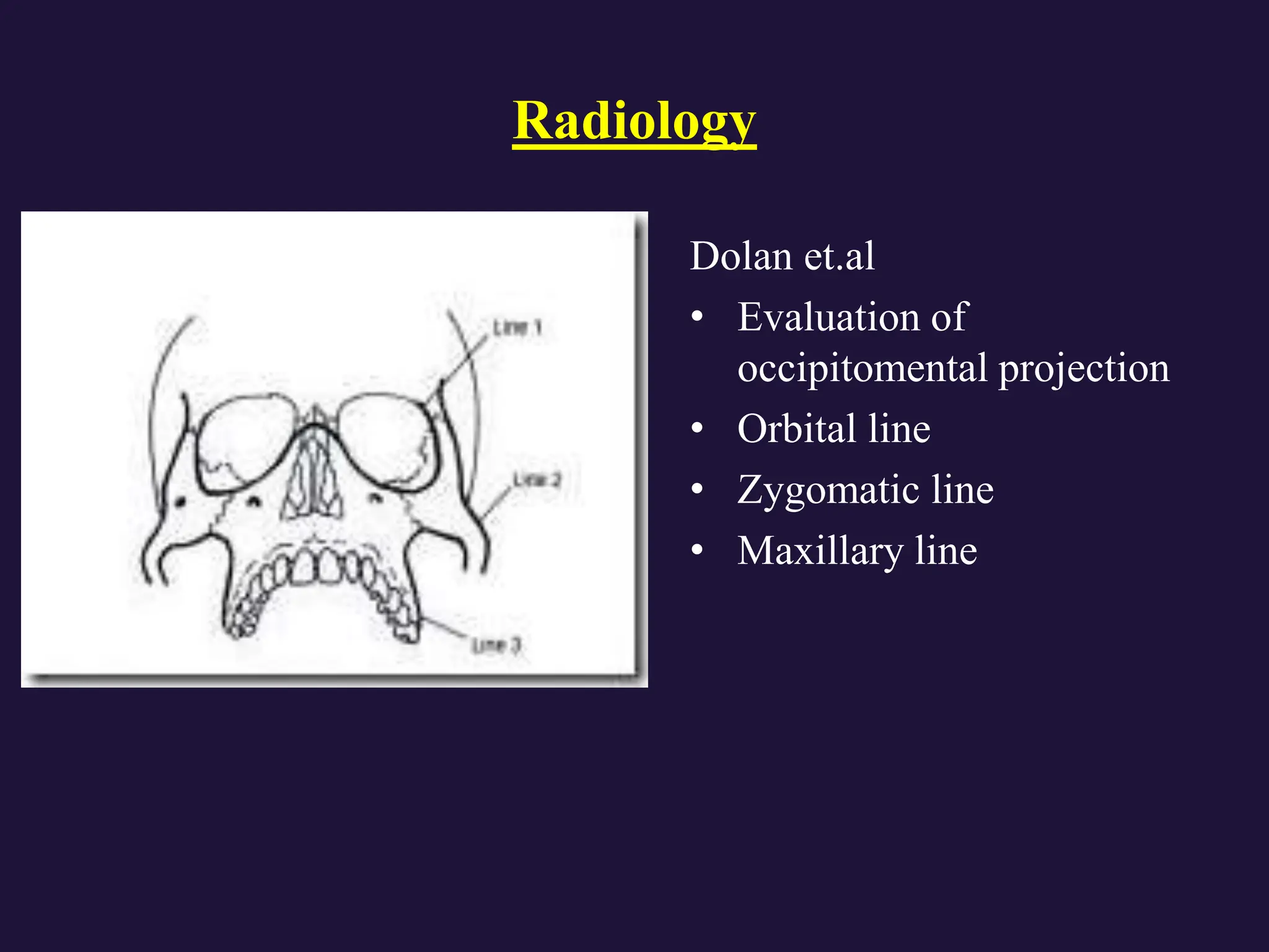 panfacial fractures- anatomy, clinical features, radiology.pptx