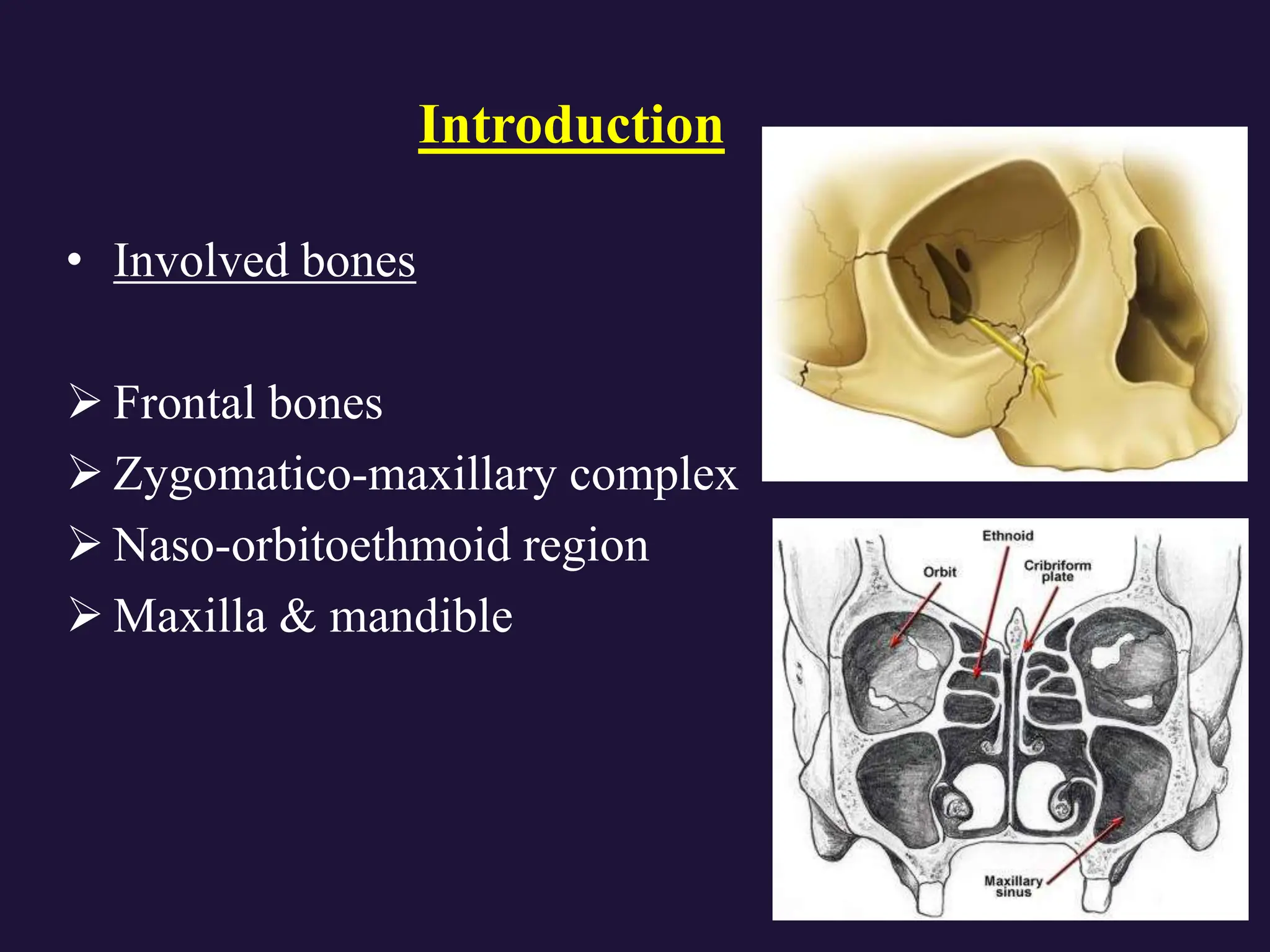 panfacial fractures- anatomy, clinical features, radiology.pptx