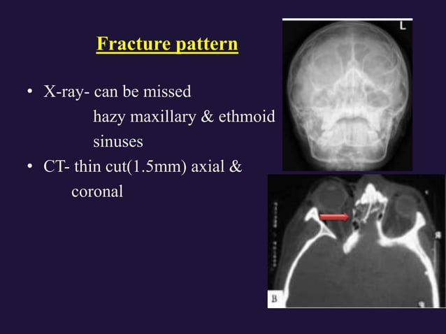 panfacial fractures- anatomy, clinical features, radiology.pptx | Death ...