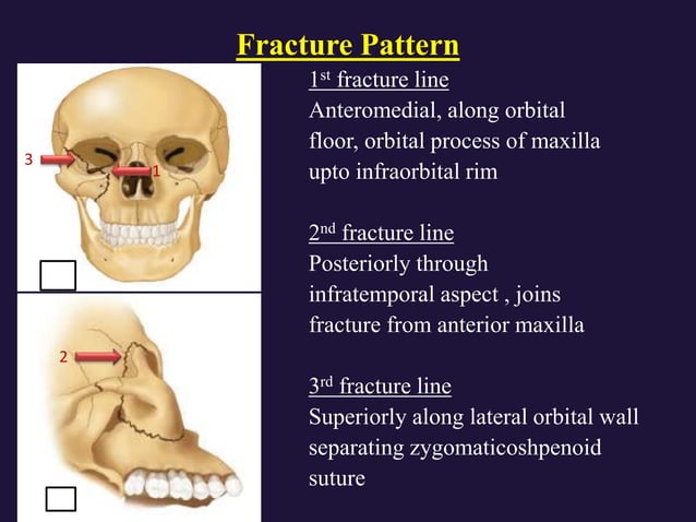 panfacial fractures- anatomy, clinical features, radiology.pptx | Death ...