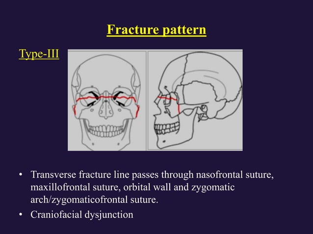 panfacial fractures- anatomy, clinical features, radiology.pptx | Death ...