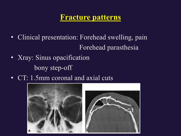 panfacial fractures- anatomy, clinical features, radiology.pptx | Death ...