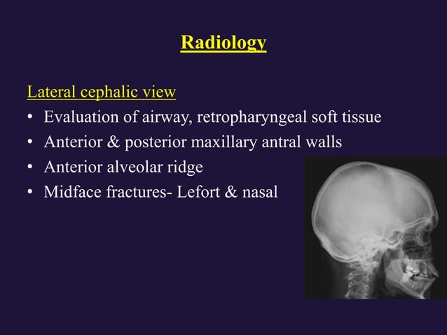 panfacial fractures- anatomy, clinical features, radiology.pptx | Death ...