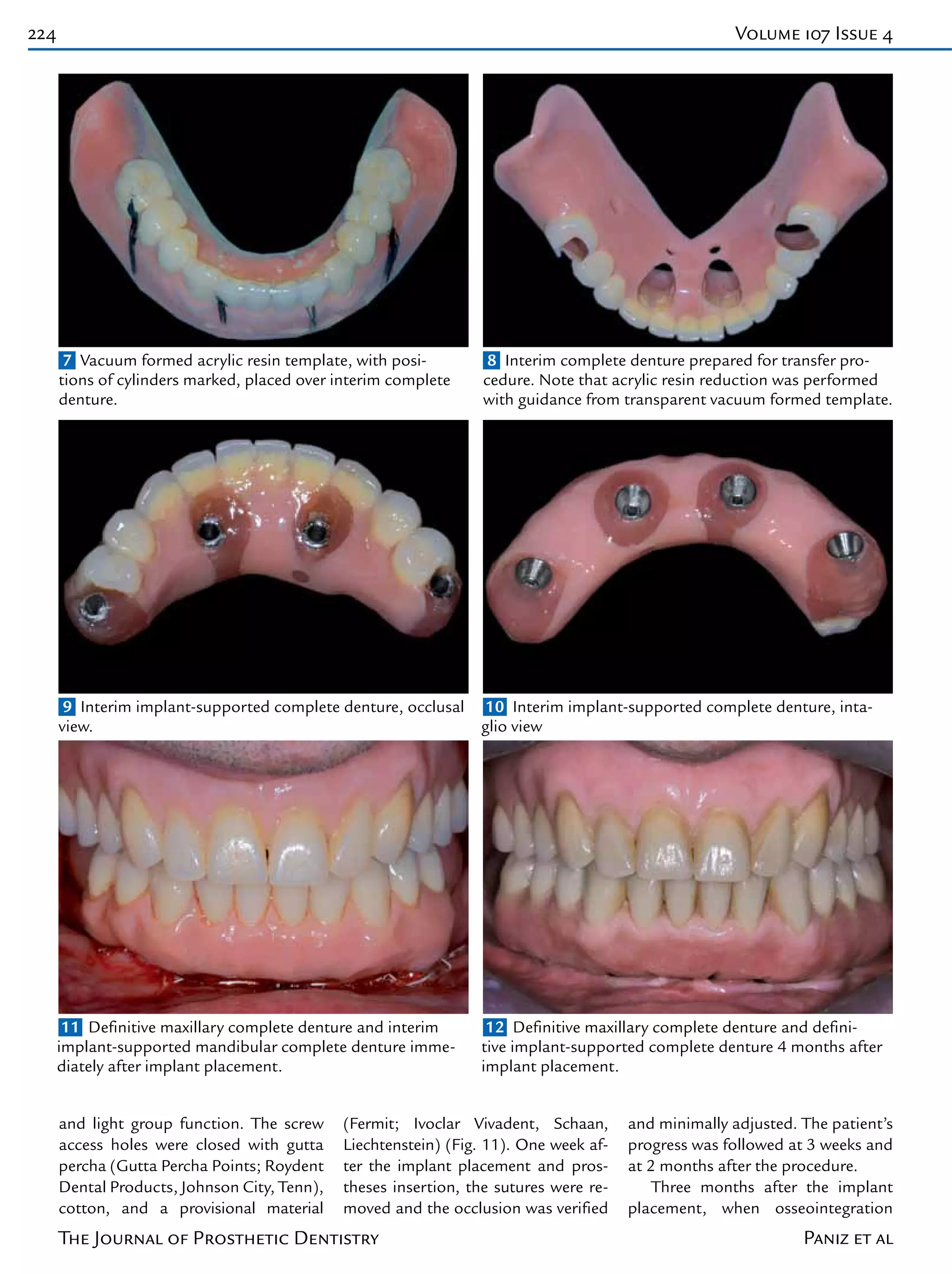 A technique for immediate occlusal implant loading of a completely ...