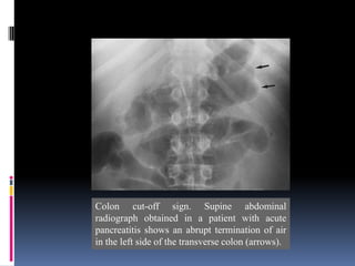 Pankreatitis akut ppt by skl | PPTX